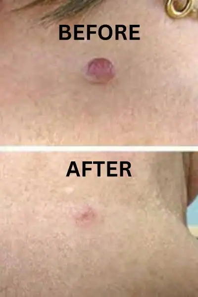 Best Skin Tag Removal Solution in Leicestershire, UK